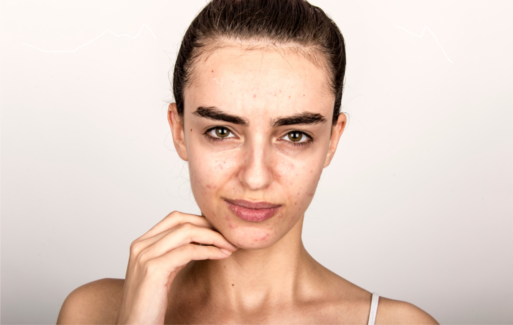 Building Confidence With Acne - Berozgaaridur.com